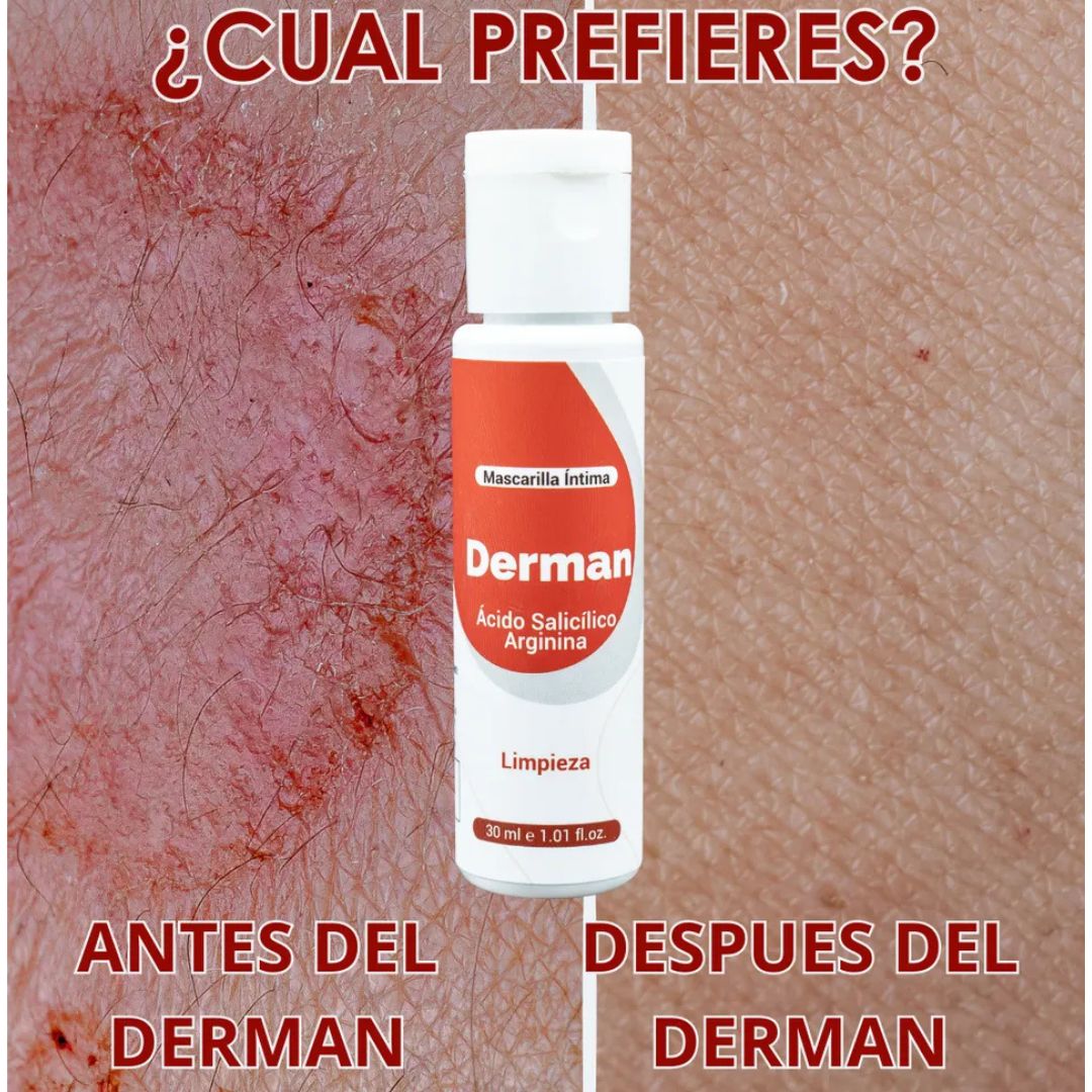 Derman® Crema íntima para hongos y bacterias – Telotengoshop